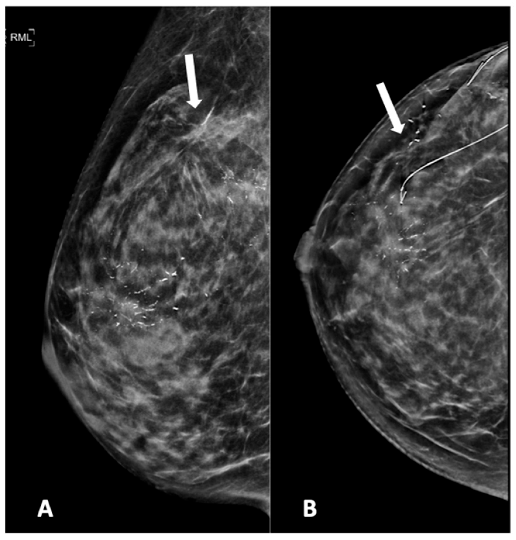 Association Between Microcalcification Patterns in Mammography and ...