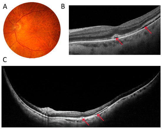 Ultra-Widefield Retinal Optical Coherence Tomography (OCT) and Angio ...