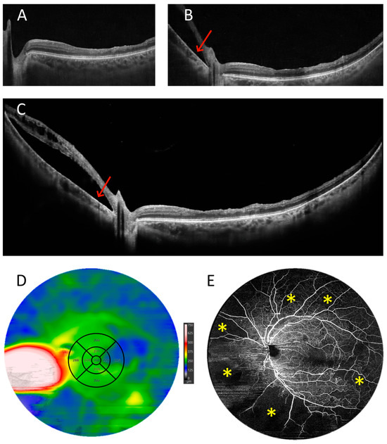 Ultra-Widefield Retinal Optical Coherence Tomography (OCT) and Angio ...