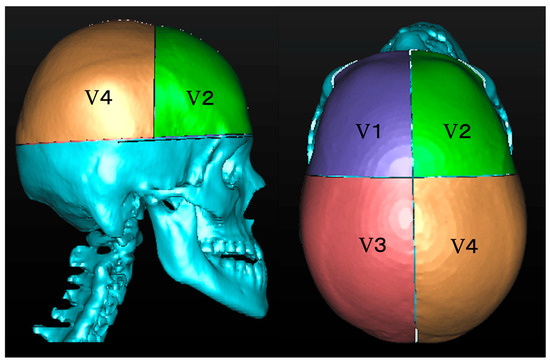 Cranial Vault Deformation and Its Association with Mandibular Deviation ...
