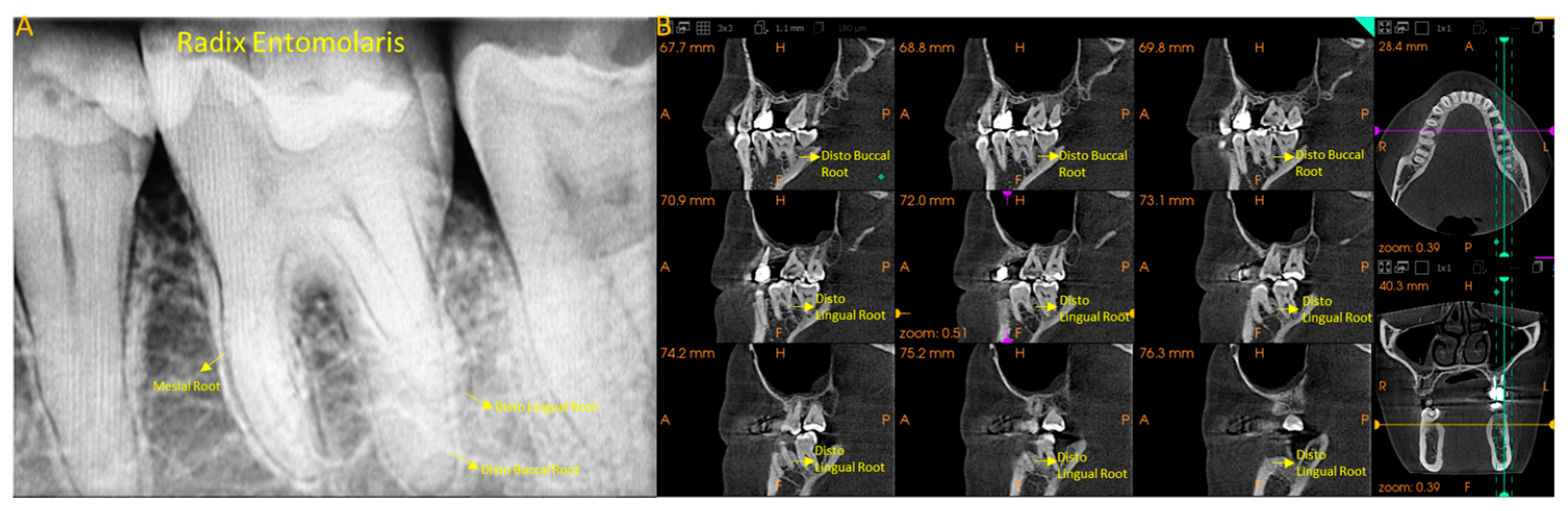 Radix Entomolaris and Complex Incisor Anatomy in a Saudi Cohort: A ...