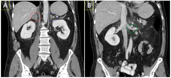 Performance of Computed Tomography of the Kidneys, Ureter and Bladder ...