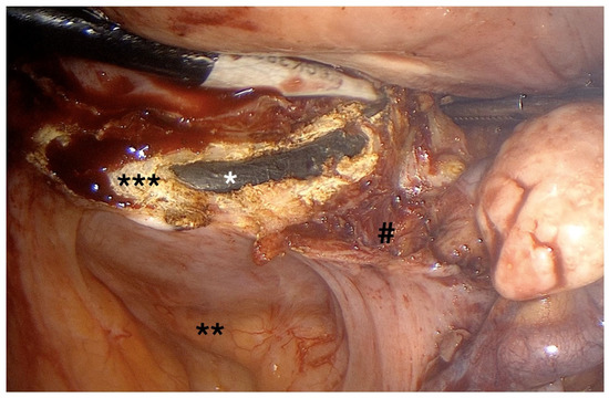 A Stepwise Anatomy-Based Protocol for Total Laparoscopic Hysterectomy ...