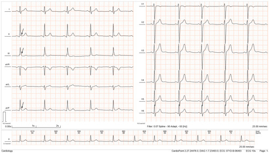 Dynamic Echocardiographic Changes Induced by Exercise in Healthy, Young ...