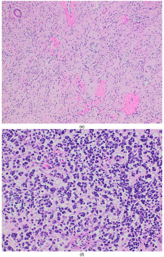CIC-Rearranged Sarcoma: A Clinical and Pathological Study of a Peculiar ...