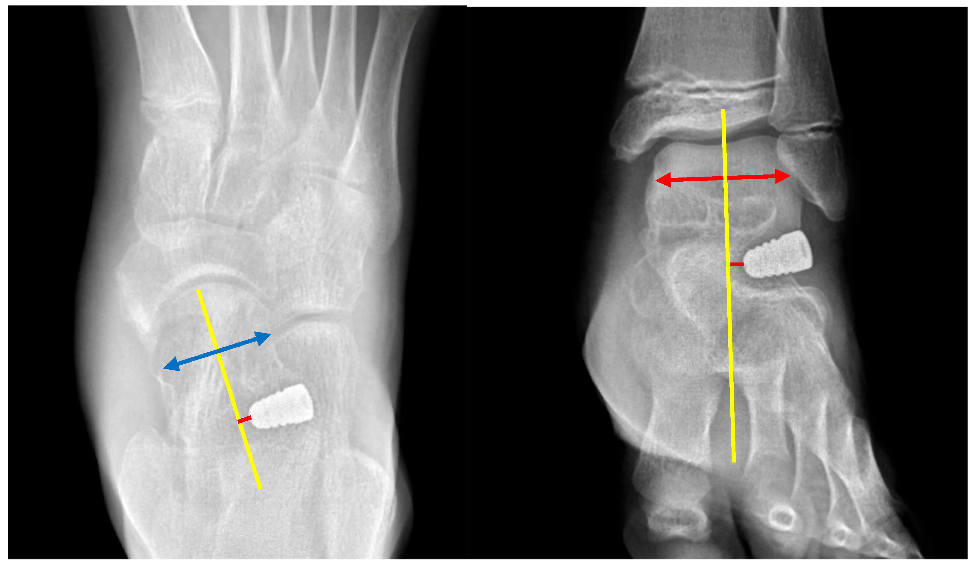 Implant Migration and Clinical Outcomes in Pediatric Symptomatic ...