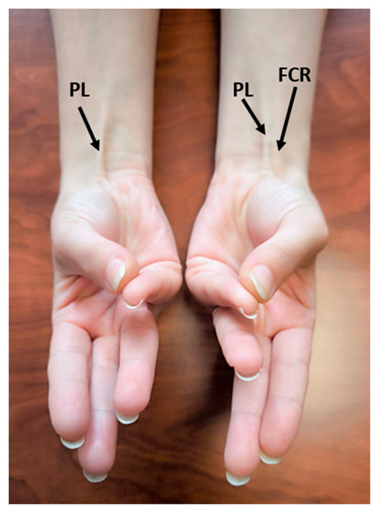 Investigation of the Effect of Palmaris Longus Presence on the Upper ...