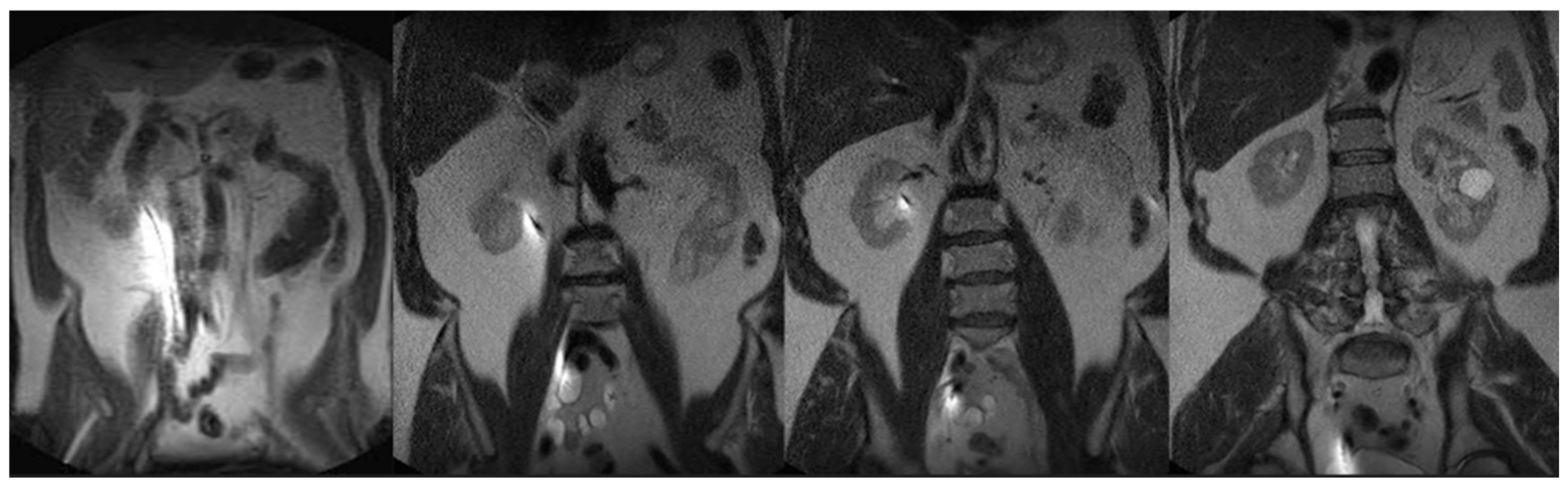 In-Bore MRI-Guided Ureteral Stent Placement During Prostate Cancer ...