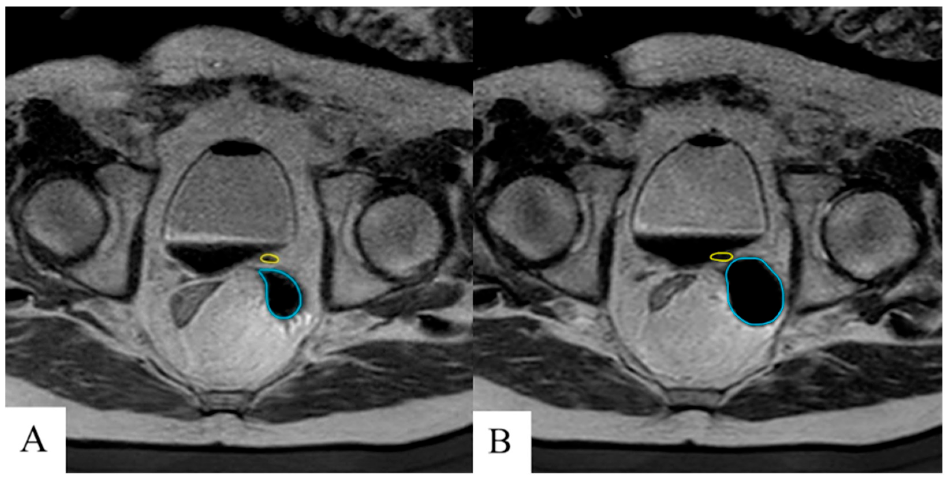In-Bore MRI-Guided Ureteral Stent Placement During Prostate Cancer ...