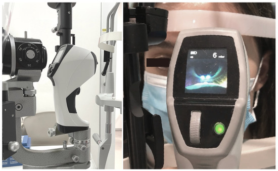 Evaluation of Corneal Sensitivity: Tools We Have