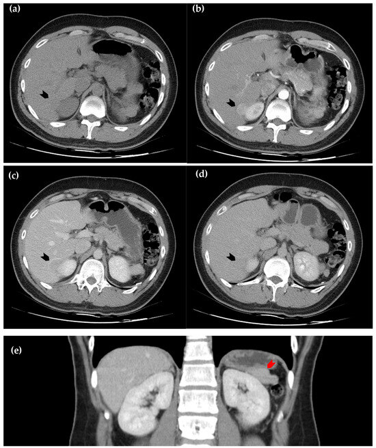 Imaging Findings of a Rare Intrahepatic Splenosis, Mimicking Hepatic Tumor