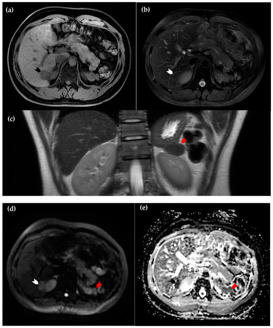 Imaging Findings of a Rare Intrahepatic Splenosis, Mimicking Hepatic Tumor