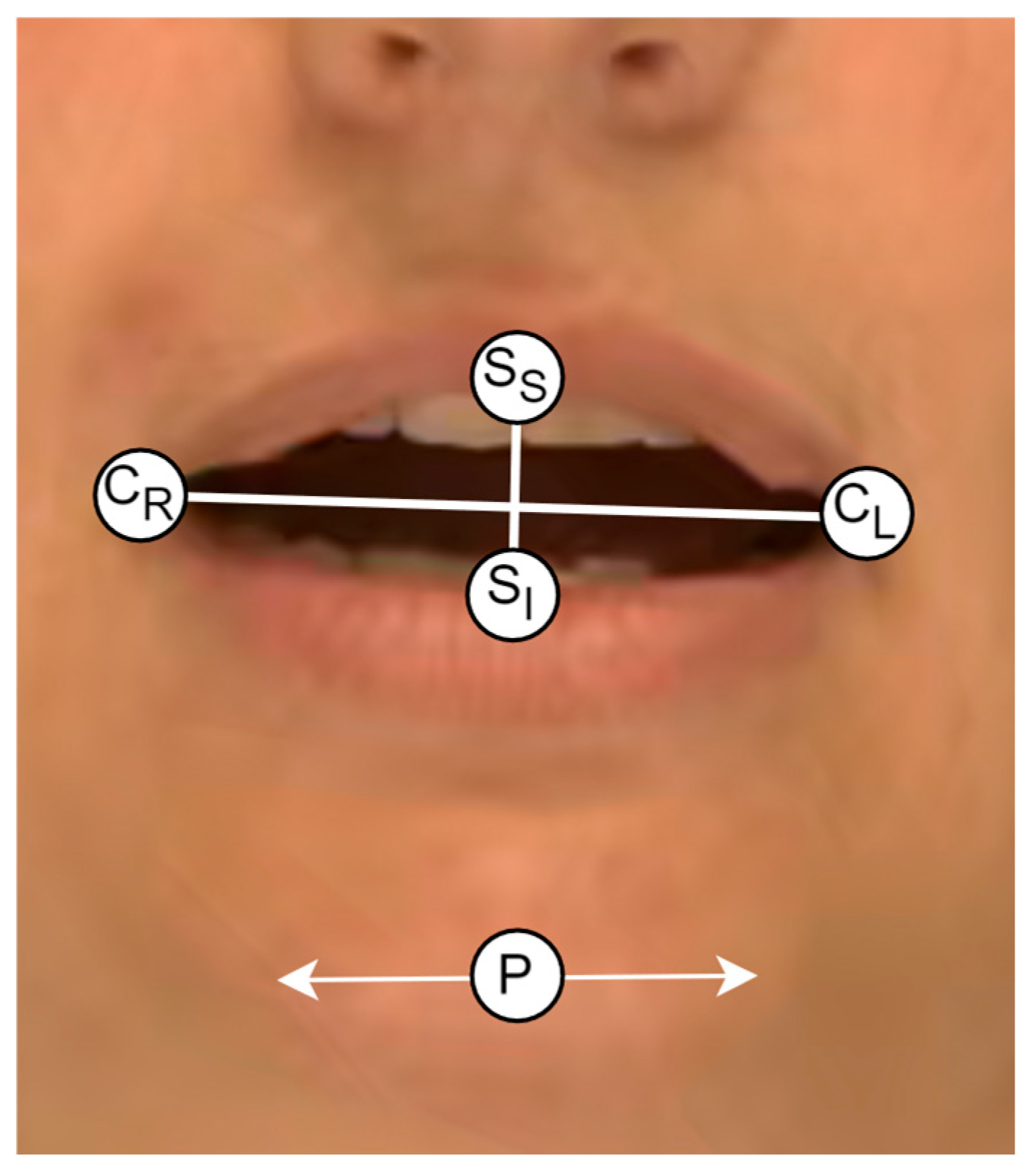 Discriminating Children with Speech Sound Disorders from Children with ...