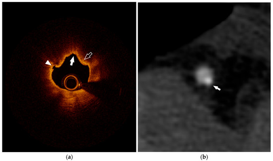 Machine Learning for Coronary Plaque Characterization: A Multimodal ...