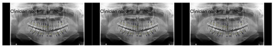 Advances in Periodontal Diagnostics: Application of MultiModal Language ...