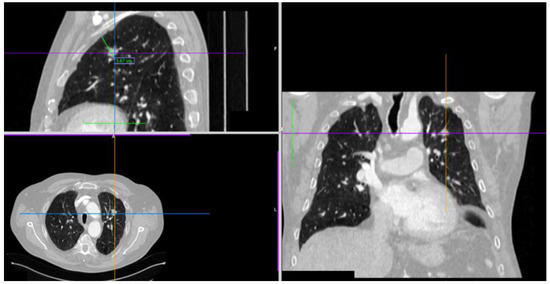 Radial-Probe Endobronchial Ultrasound as Part of Different Navigational ...