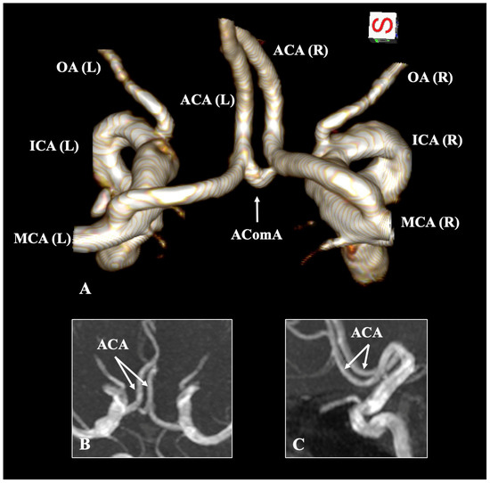 Morphological Variations of the Anterior Cerebral Artery: A Systematic ...