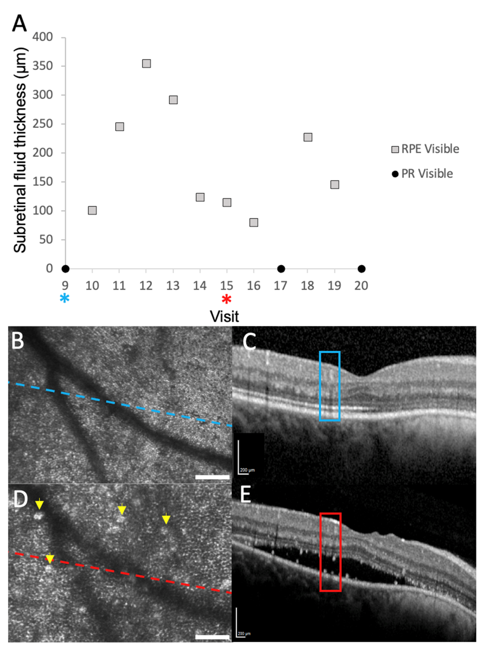 Longitudinal High-Resolution Imaging of Retinal Sequelae of a Choroidal ...