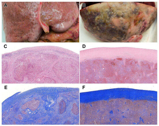 Hepatic and Splenic Hyaloserositis