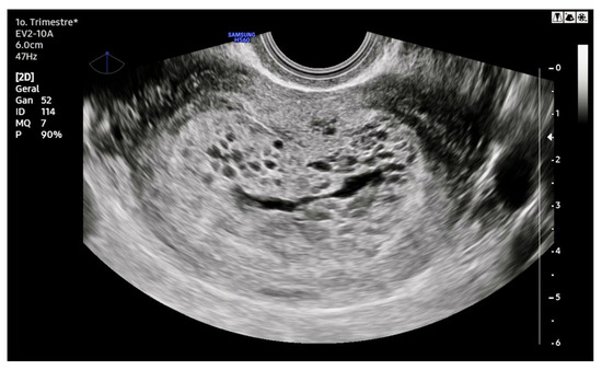 Molar Pregnancy: Early Diagnosis, Clinical Management, and the Role of ...