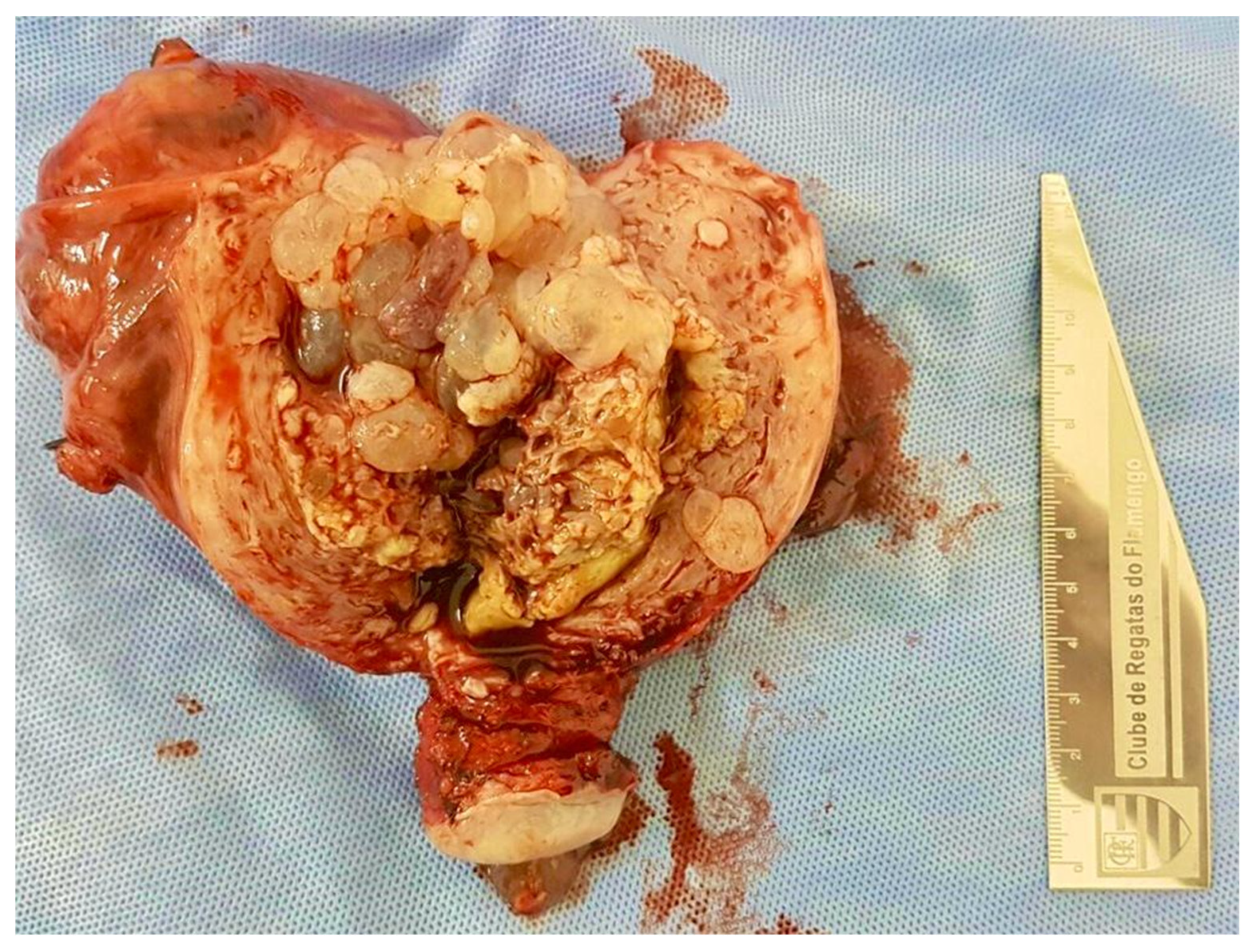 Molar Pregnancy: Early Diagnosis, Clinical Management, and the Role of ...