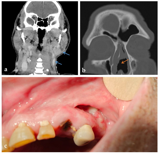 Cocaine-Triggered PR3-ANCA Vasculitis Localized to a Post-Surgical Neck ...
