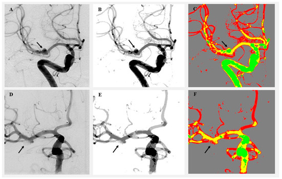Quantitative DSA Analysis of MCA Aneurysms Using SymDIRECT Pixel ...
