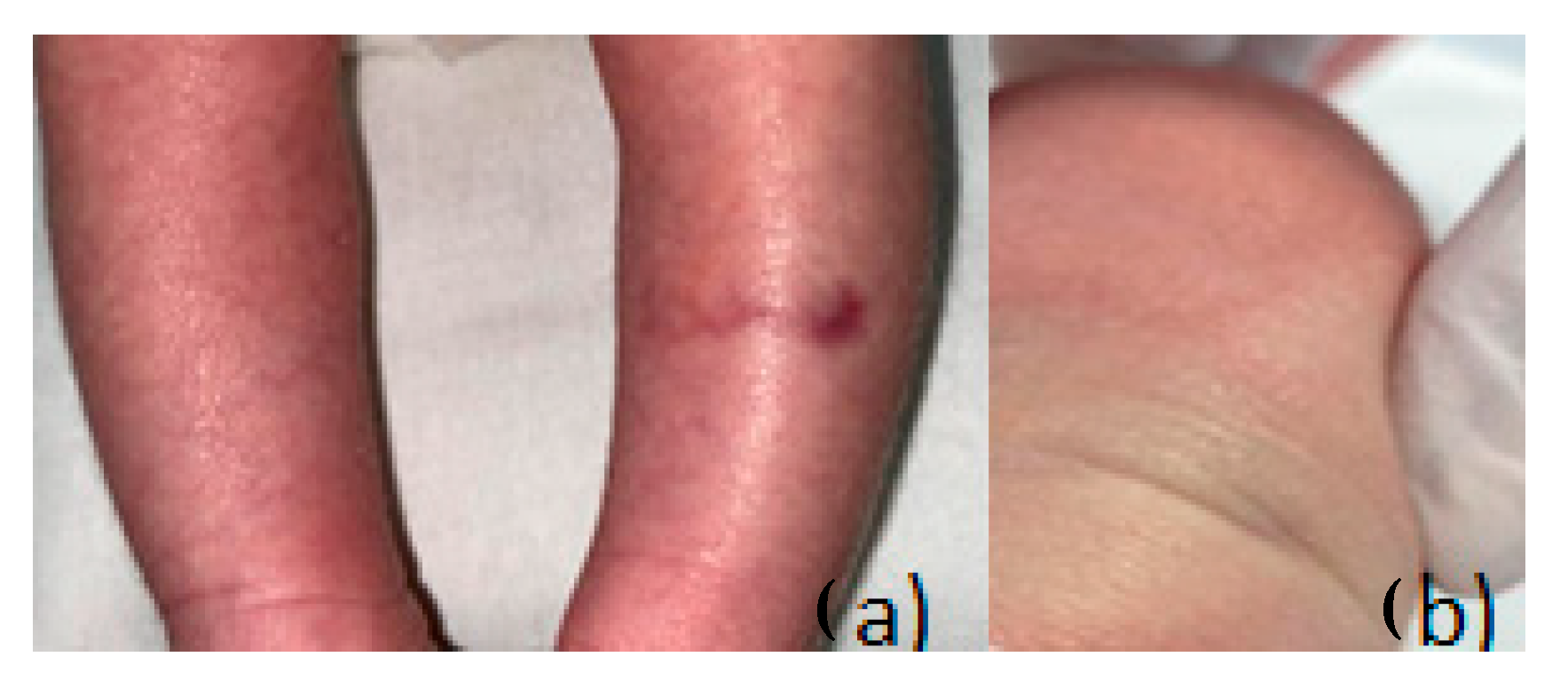 Cutis Marmorata Telangiectatica Congenita: Case Series and Literature ...