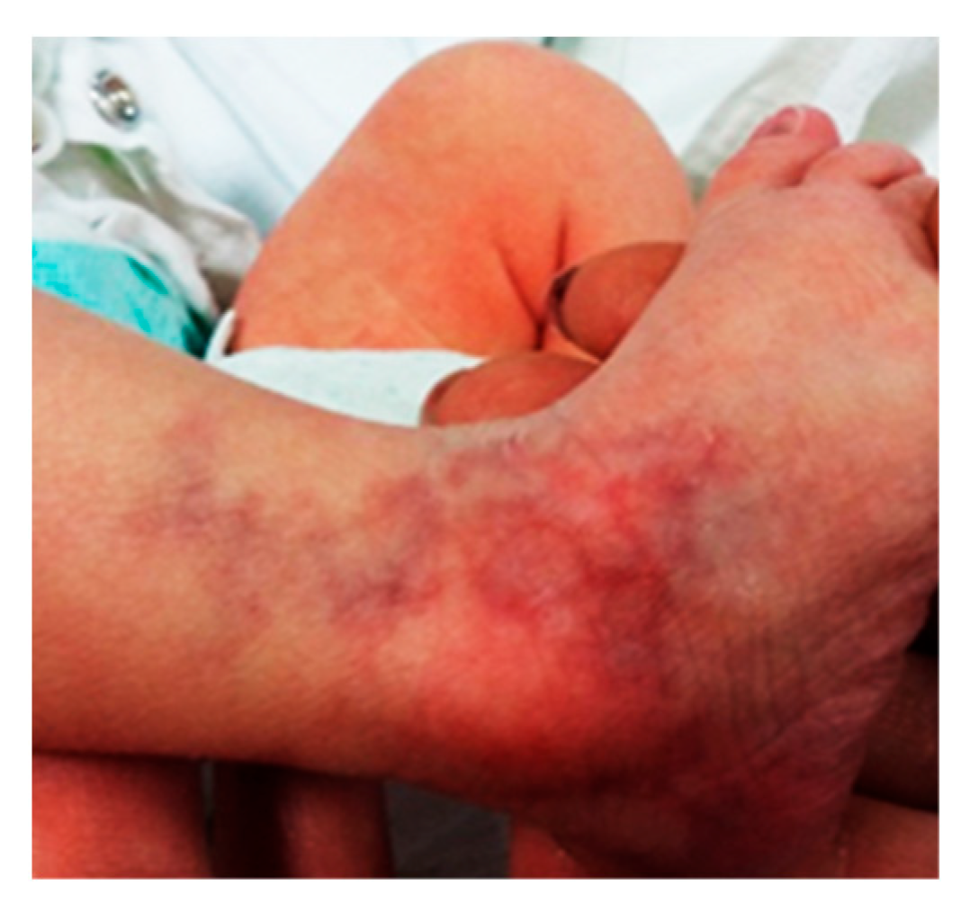 Cutis Marmorata Telangiectatica Congenita: Case Series and Literature ...