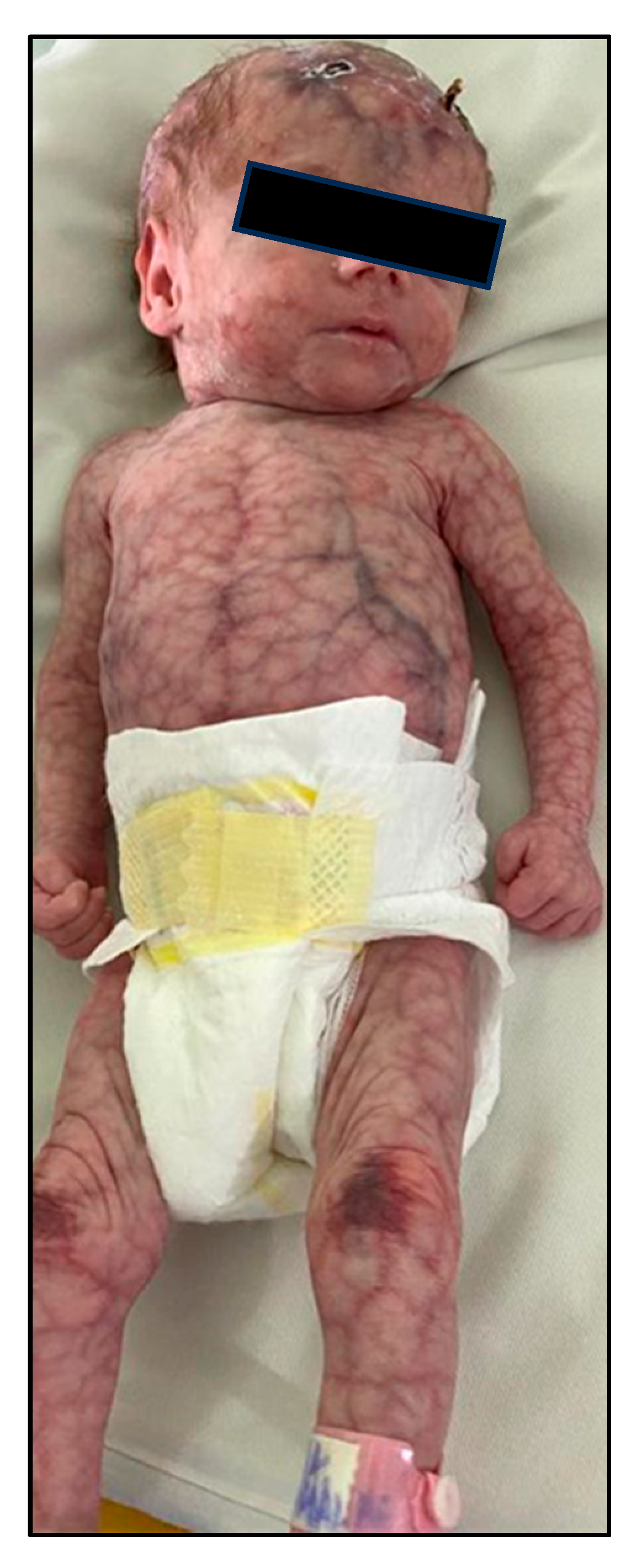 Cutis Marmorata Telangiectatica Congenita: Case Series and Literature ...