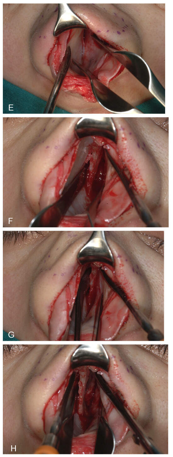 New Insights into the Role of Columellar Strut and Septal Extension ...
