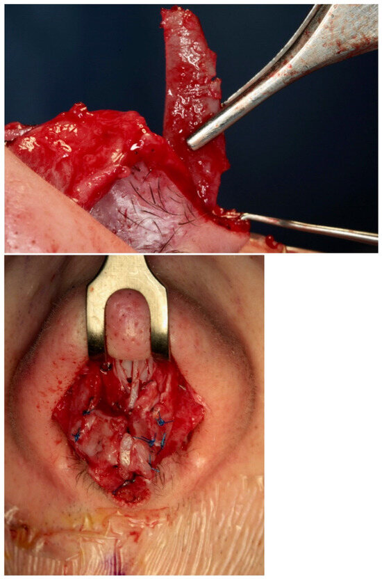 New Insights into the Role of Columellar Strut and Septal Extension ...
