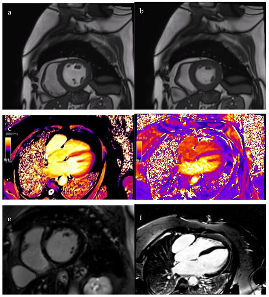 Incidental Discovery of a Right Atrial Diverticulum in an Adult Patient