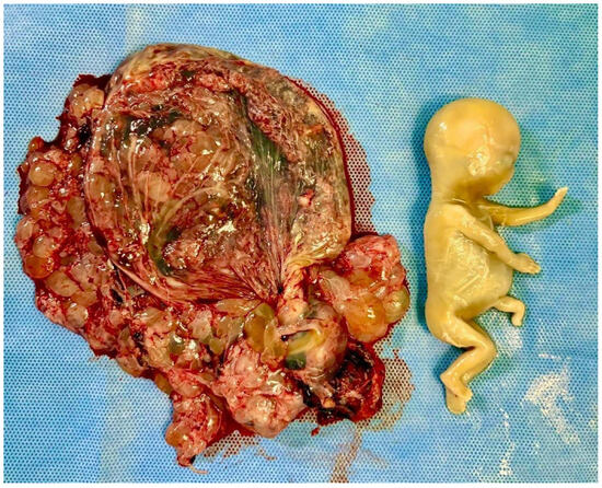 Diagnosis and Surgical Treatment of Hydatidiform Mole