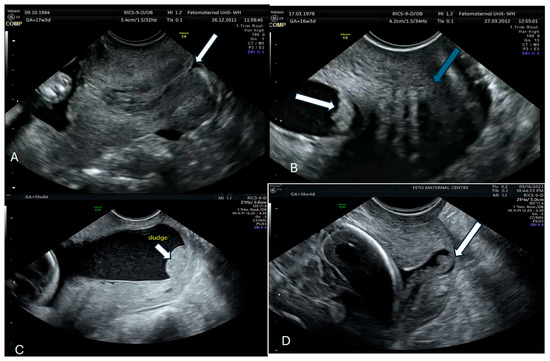 Infections as a Cause of Preterm Birth: Amniotic Fluid Sludge—An ...