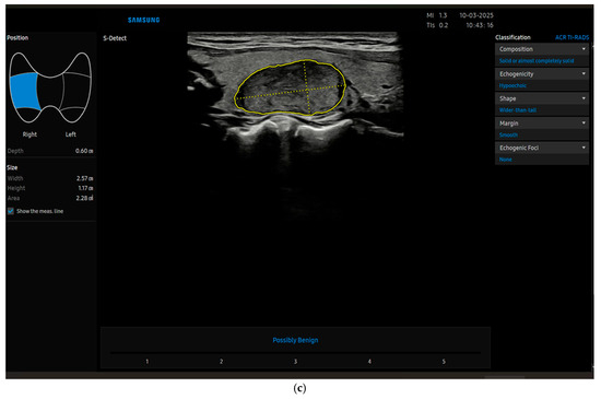 Thyroid Nodule Characterization: Which Thyroid Imaging Reporting and ...