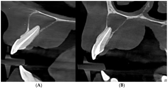 Palatal Abscess of Endodontic Origin with Extensive Radiolucency in ...