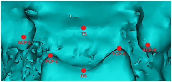 Sella Turcica and Cranial Base Symmetry in Anterior Synostotic ...