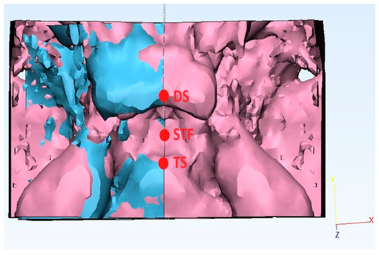 Sella Turcica and Cranial Base Symmetry in Anterior Synostotic ...