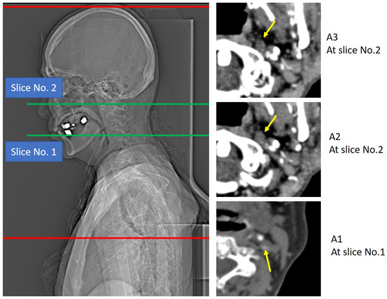 Differentiating True Occlusion from Pseudo-Occlusion: The Role of ...