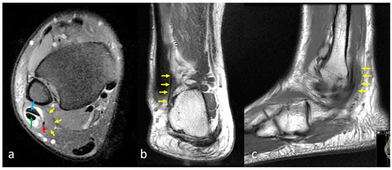 Prevalence of the Peroneus Quartus Muscle and Its Association with ...