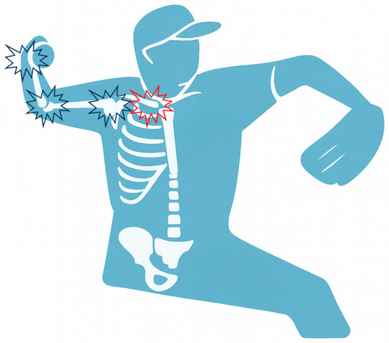 Innovative Dynamic Ultrasound Diagnosis of First Rib Stress Fracture in ...
