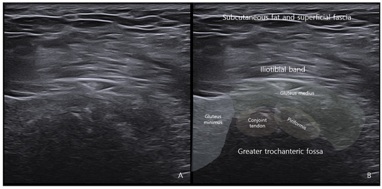 Beyond Nerve Entrapment: A Narrative Review of Muscle–Tendon ...
