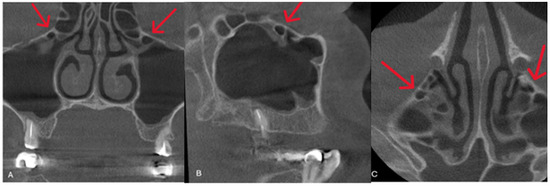 Assessment of the Relationship Between Haller Cells, Accessory ...