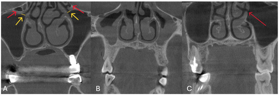 Assessment of the Relationship Between Haller Cells, Accessory ...
