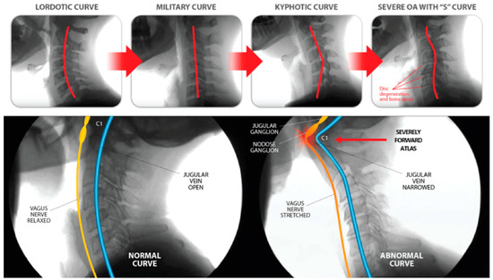 Cervical Oculopathy: The Cervical Spine Etiology of Visual Symptoms and ...