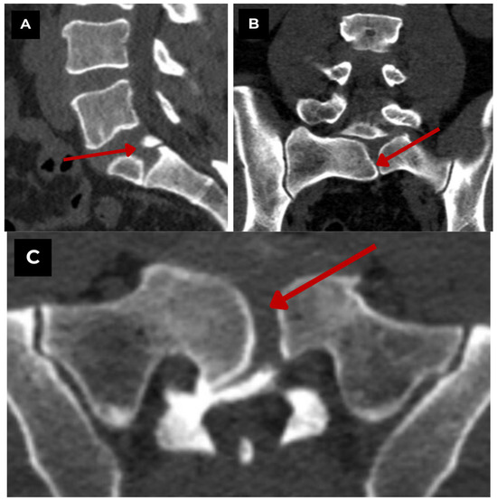 Two Cases of Singular Sacral S1 Butterfly Vertebra