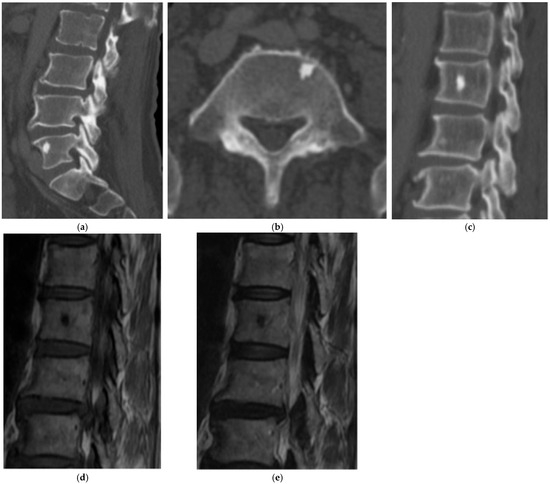 Unveiling Primary Bone Tumors of the Spine: A Review of Essential ...