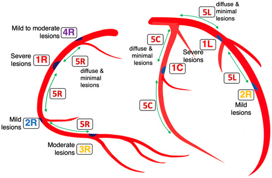 Codify and Localize Lesions on a Coronary Acoustic Map: Scientific ...