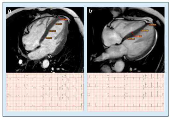 Multimodality Imaging in Apical Hypertrophic Cardiomyopathy: Can ...